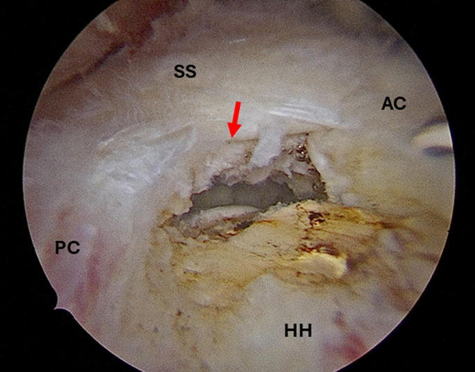 Are we misunderstanding rotator cuff lesions? - Age-based patterns of ...