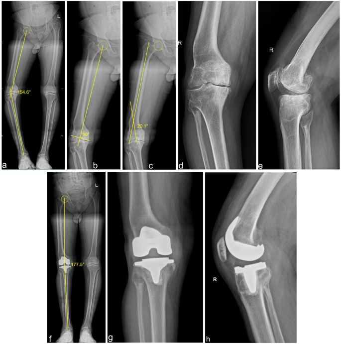 Imageless robotic-assisted total knee arthroplasty allows intra ...