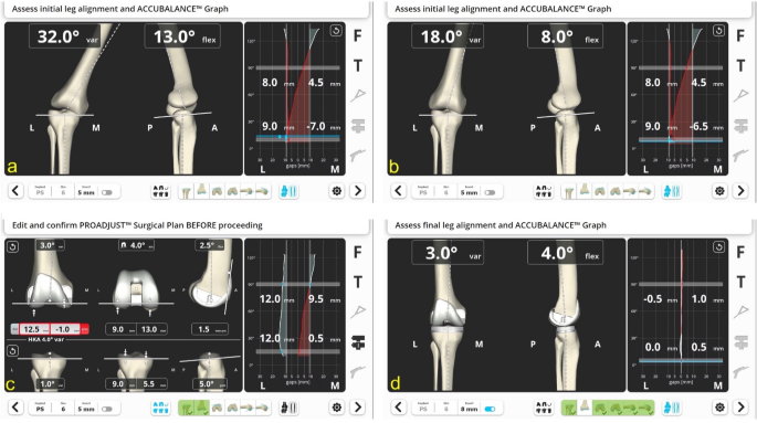 Imageless robotic-assisted total knee arthroplasty allows intra-articular correction of severe ...