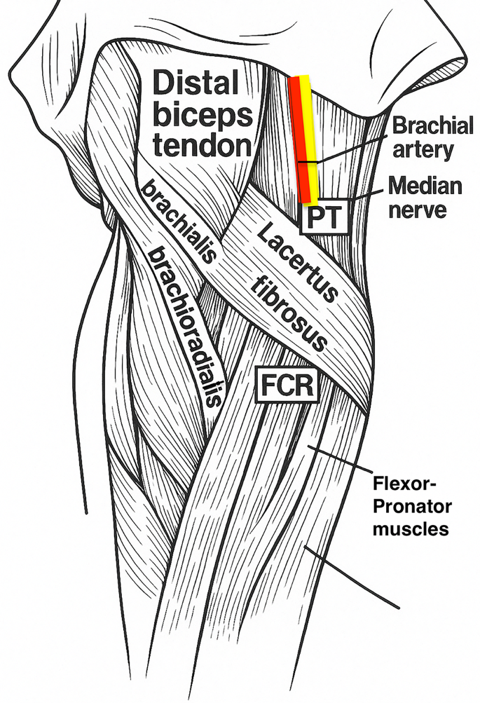 Current perspectives on lacertus syndrome: clinical features, diagnosis, and treatment ...