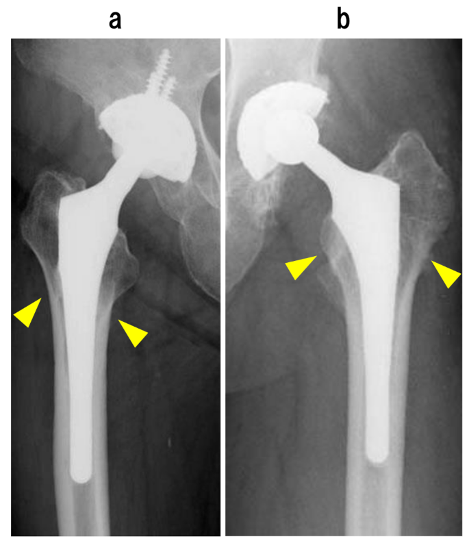 Long-term results of the metaphyseal-loading anterolaterally flared ...