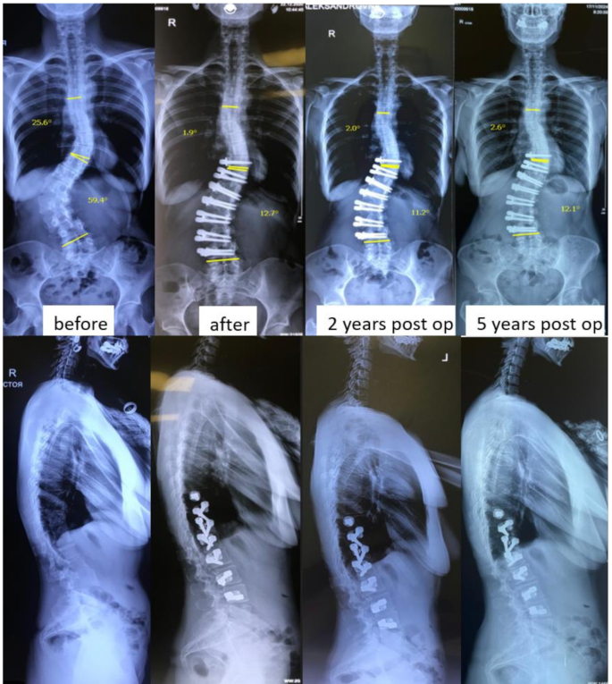 Anterior scoliosis correction in patients over forty years: results ...