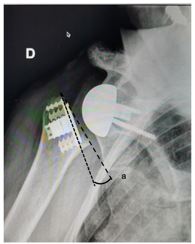 No impact of osteoporosis on stemless reverse shoulder arthroplasty ...