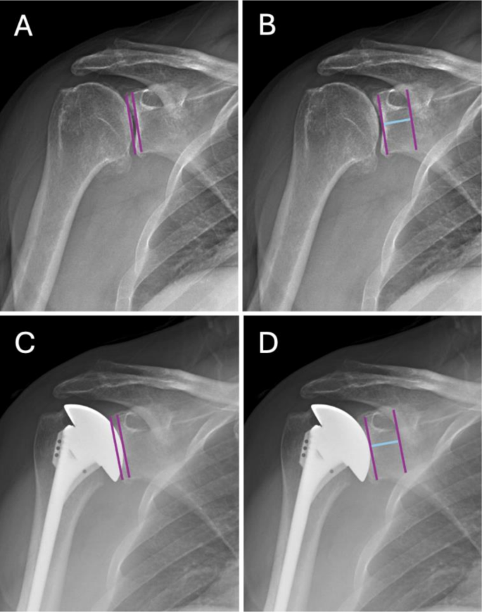 Is glenoid medialization after hemiarthroplasty with concentric glenoid ...