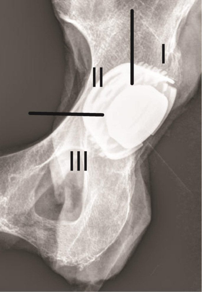 Osseointegration of threaded acetabular cups - radiological and ...