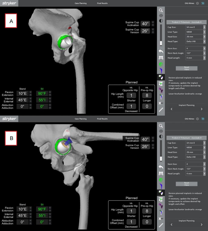 Beyond jump distance: modular dual mobility versus single mobility cups ...