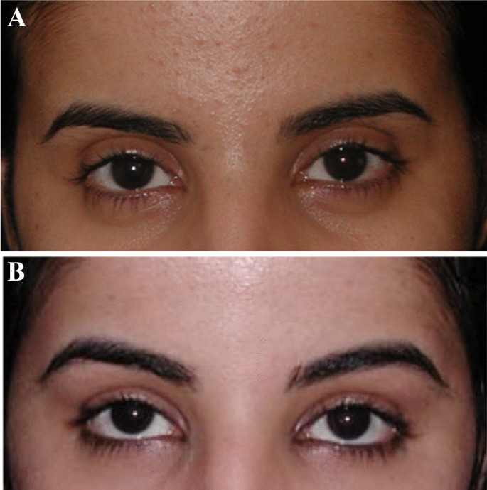 15 Years of Upper Eyelid Micro-fat Graft: the Good, the Bad and the ...