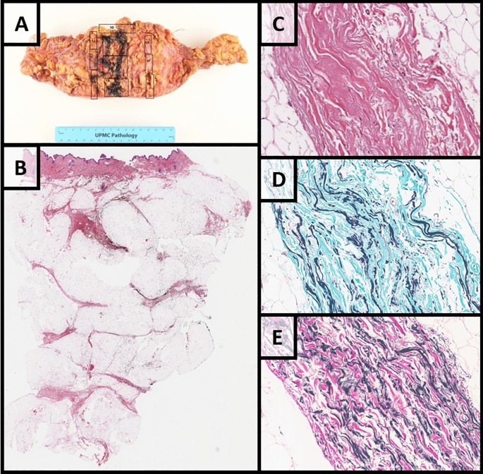 The Role of Suprapubic Superficial Fascial System Reconstruction During ...