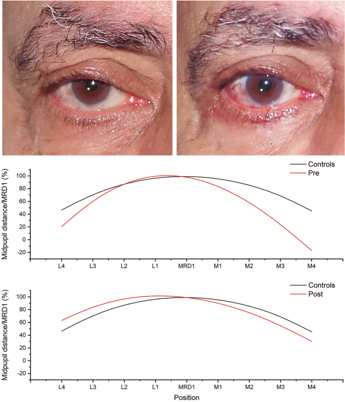 Upper Eyelid Contour Changes After Müller’s Muscle Conjunctiva ...