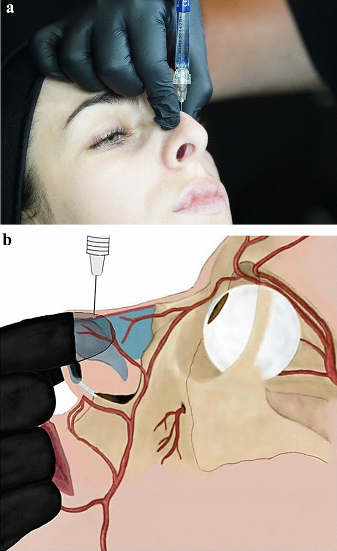 Nonsurgical Rhinoplasty: Results from a Retrospective Study of Rino-4 ...
