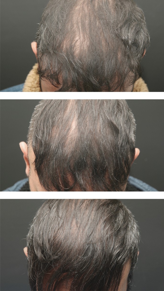 Effectiveness of Exosome Treatment in Androgenetic Alopecia: Outcomes ...