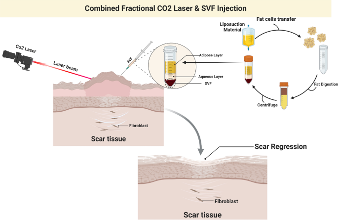 Combined Stromal Vascular Fraction and Fractional CO2 Laser Therapy for ...