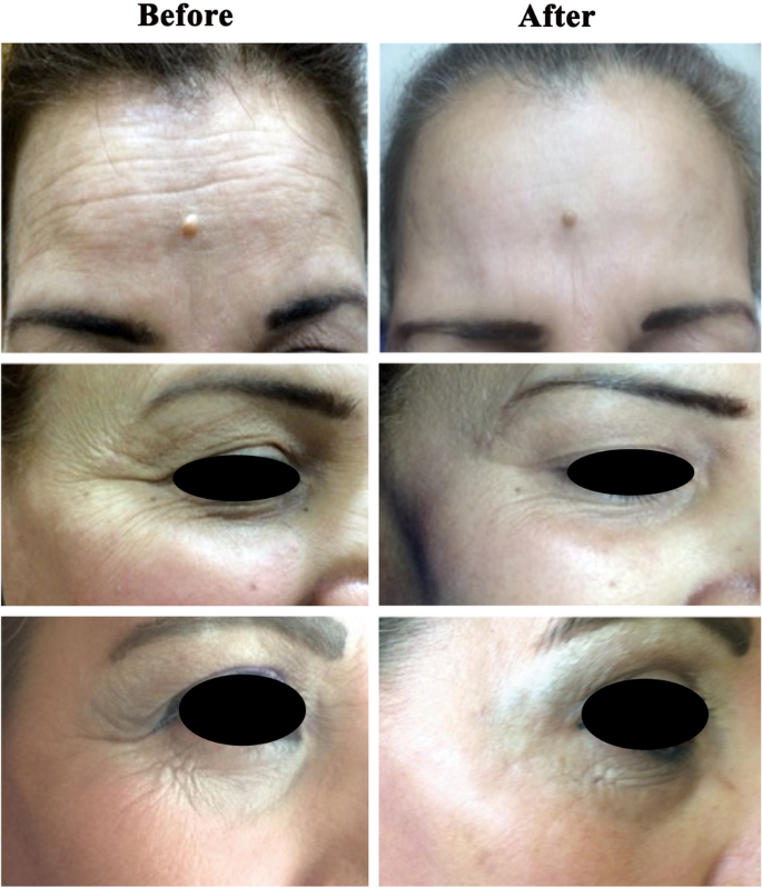 A New Approach with Combined Microneedle and Sublative Fractional ...