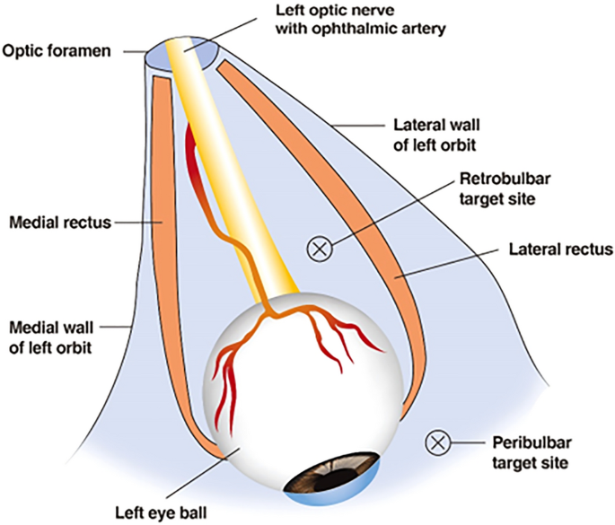 Retrobulbar Hyaluronidase Injection for Vascular Side Effects ...
