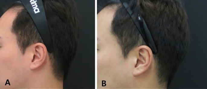 Injectable Hyaluronic Acid Filler for Increasing Head Circumference and ...