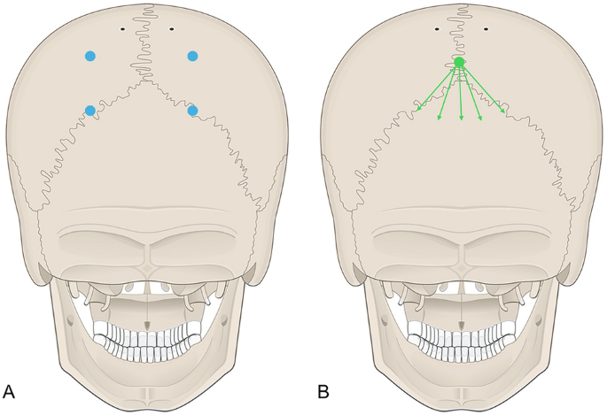 Injectable Hyaluronic Acid Filler for Increasing Head Circumference and ...