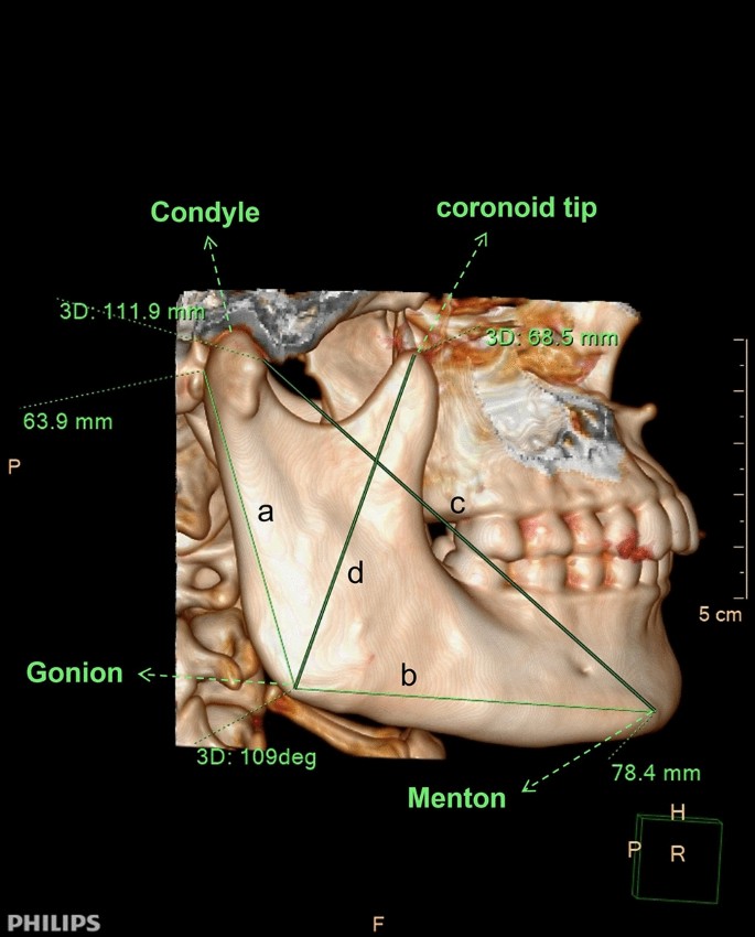 Differences in the Size and Morphology of Masseter Muscle and Mandible ...