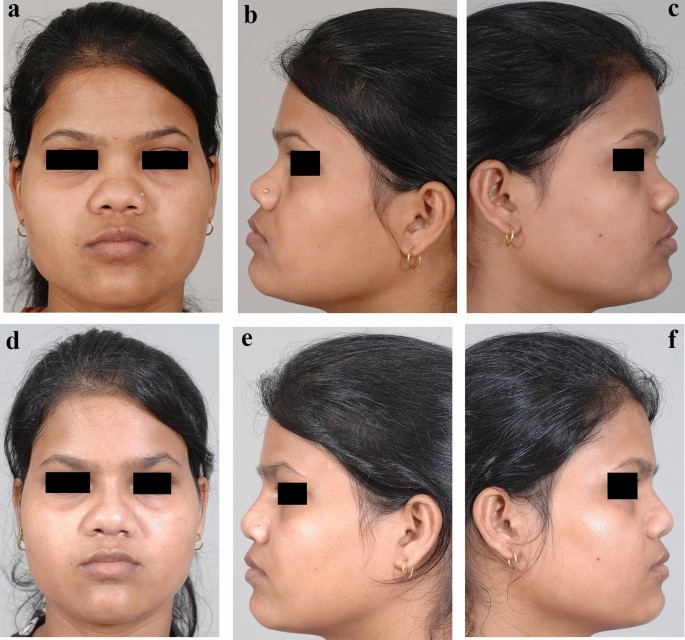 Total Anatomical Nasal Skeletal Reconstruction Using a New Autologous ...