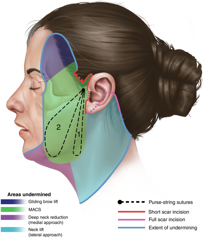 Use of Ancillary Procedures in Combination with the MACS-Lift for ...