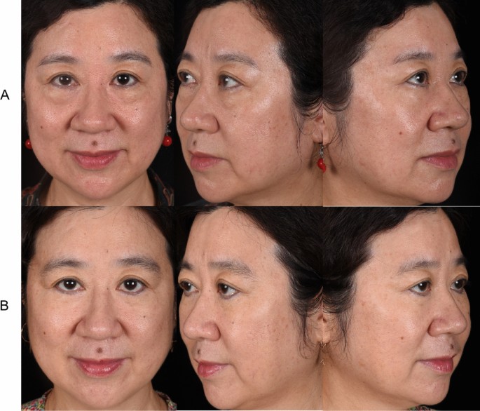 A New Method of Lower Eyelid Blepharoplasty with Tear Trough Deformity ...