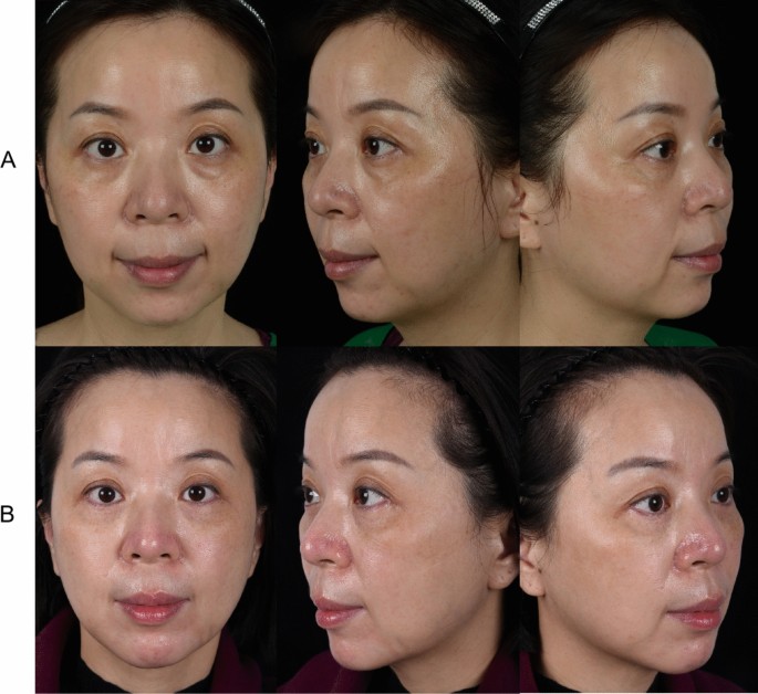 A New Method of Lower Eyelid Blepharoplasty with Tear Trough Deformity ...