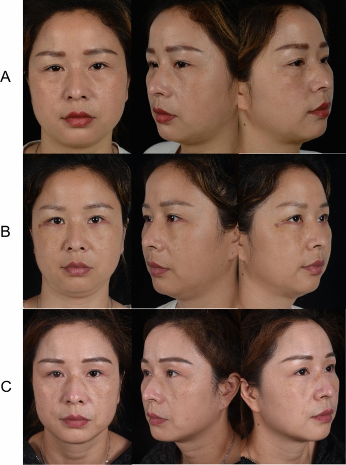 A New Method of Lower Eyelid Blepharoplasty with Tear Trough Deformity ...