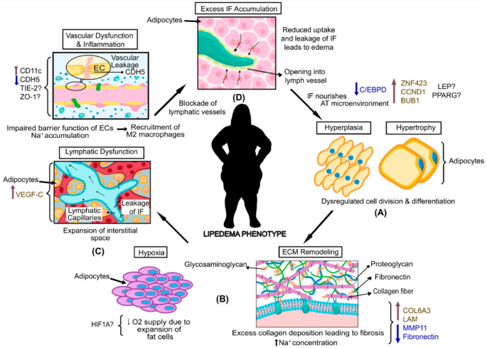 Abdominal Lipedema: Clinical Diagnosis and Management Through a ...