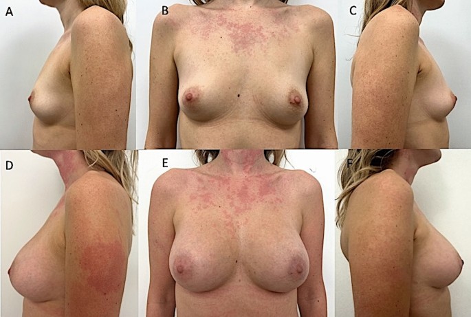 Breast Implants or Lipofilling in Augmentation Mammoplasty? A ...