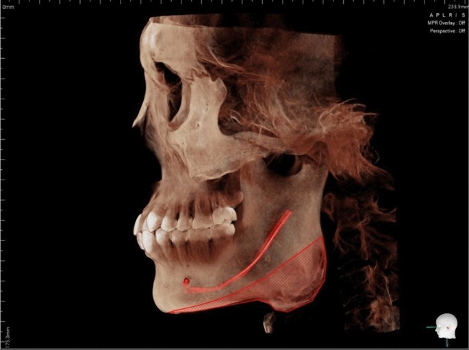 A Single-Stage Surgery of Mandibular Angle Ostectomy and Corticectomy ...