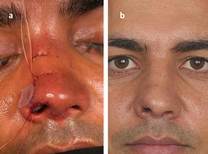 Rotational Columellar Skin Flap for Nasal Alar Rim Reconstruction ...