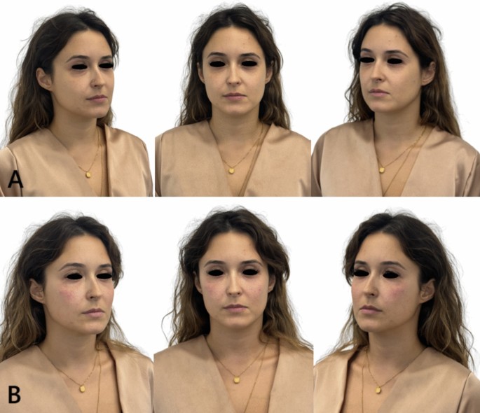 Non-surgical Approach for Periocular Aesthetic Reconstruction with ...