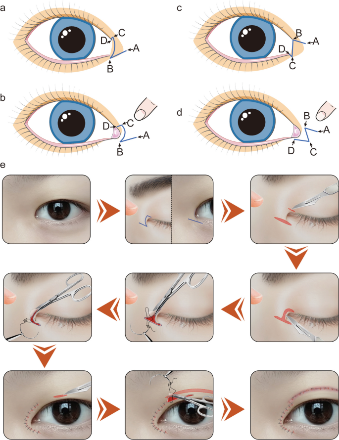 Comparison of Modified Asymmetric Inverse Z-plasty and Z-plasty in the ...