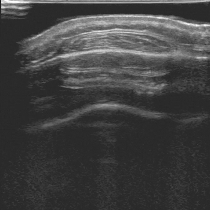 Minimally Invasive Removal of Frontal Lipoma with Endoscope | Aesthetic ...