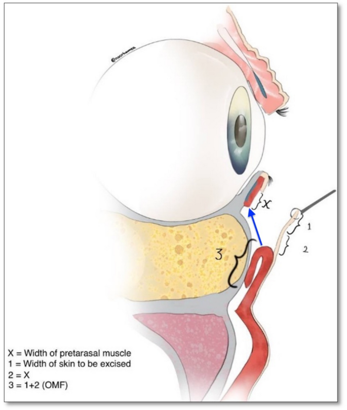 Orbicularis Muscle Folding Technique for Augmenting and Extra Support ...
