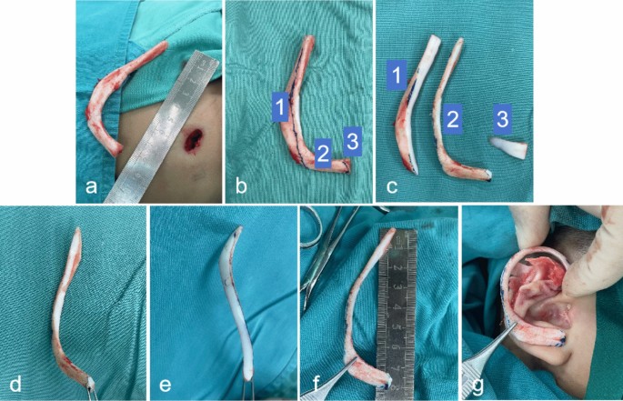 An Effective Surgical Method for Correcting Different Degrees of ...