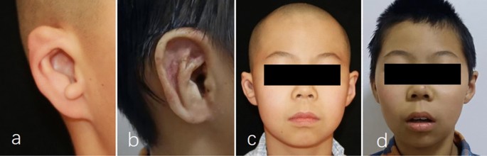 An Effective Surgical Method for Correcting Different Degrees of ...