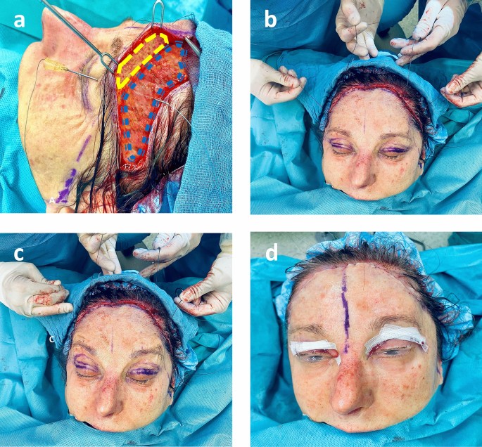 Anatomical Insights into Frontal Branch Preservation in Minimally ...