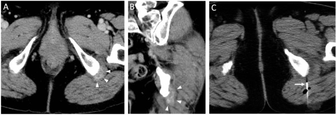 Sustained Effectiveness of Transcatheter Arterial Microembolization for ...