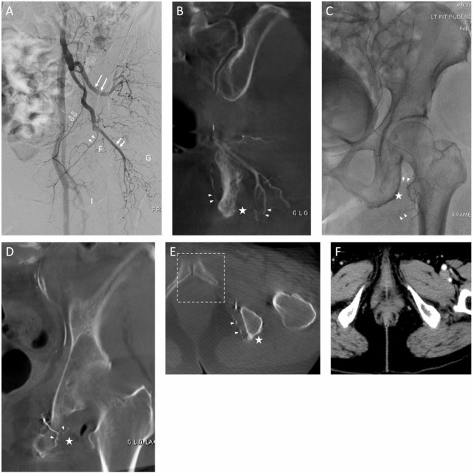 Sustained Effectiveness of Transcatheter Arterial Microembolization for ...