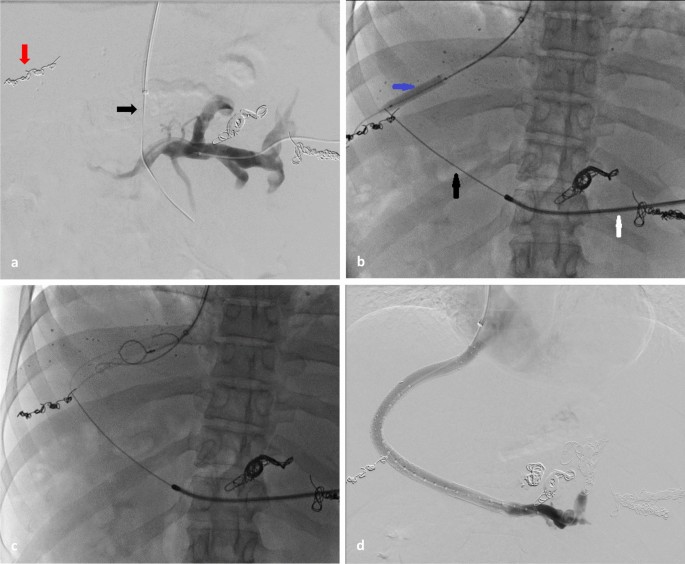 Trans-splenic Sharp Recanalization, Extra-Anatomic Portal Vein ...
