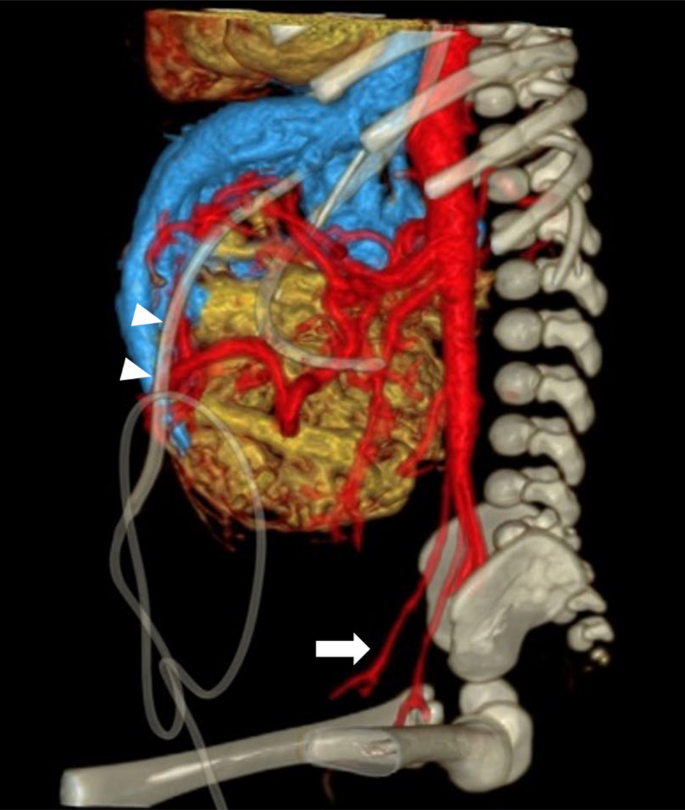 Trans-umbilical Venous Approach for Embolization of Congenital Hepatic ...