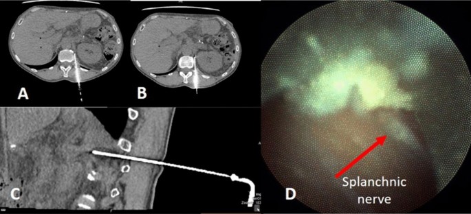 Percutaneous Cryoneurolysis of Splanchnic Nerves Under Combined ...