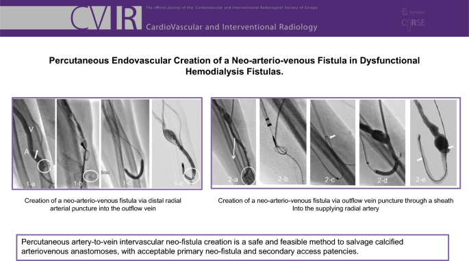 Percutaneous Endovascular Creation of a Neo-arteriovenous Fistula in ...