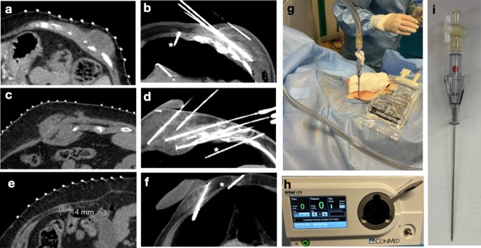 Stable Pneumoperitoneum Using an Automatic CO2 Insufflation Machine for ...