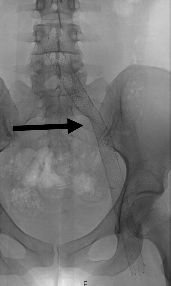 Complications of Deep Venous Stenting and Their Management ...