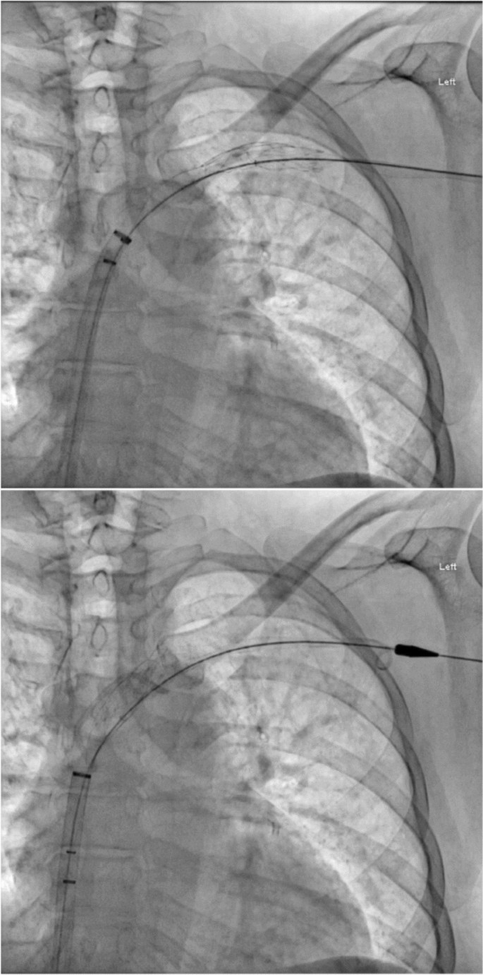 Novel Bail-Out Technique for the Recovery of Torn, Wall-Adherent Port ...