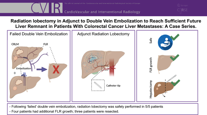 Radiation Lobectomy in Adjunct to Double Vein Embolization to Reach ...
