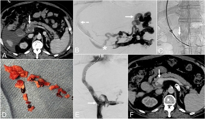 Splanchnic Venous Thrombectomy Using the VenaCore Thrombectomy Catheter ...