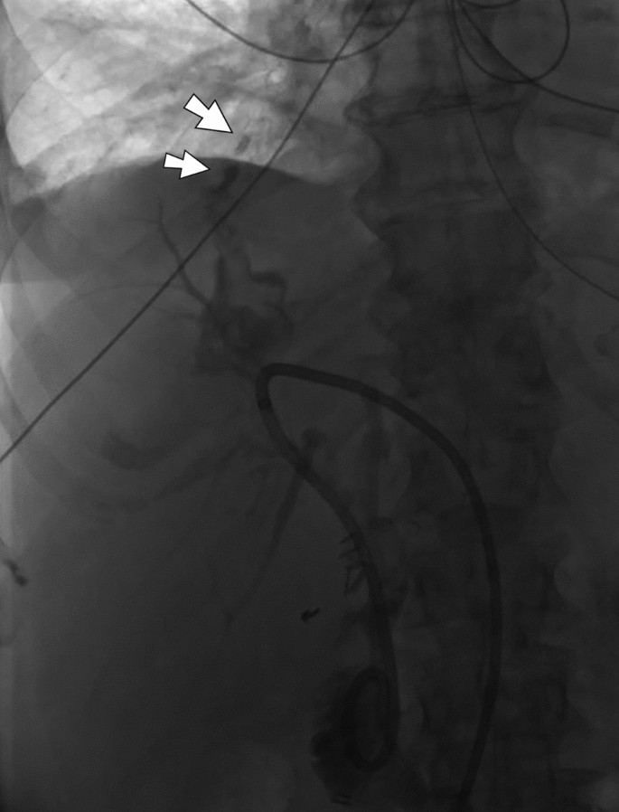Novel Application of a Shear-Thinning Conformable Embolic Gel for ...