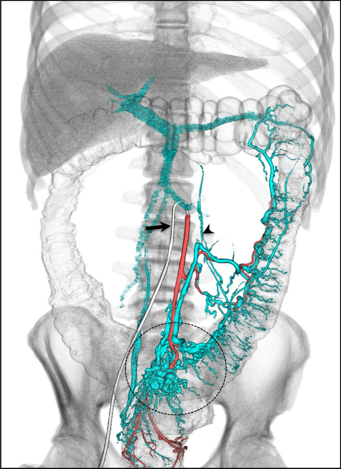Successful Treatment of Inferior Mesenteric Arteriovenous Malformation ...